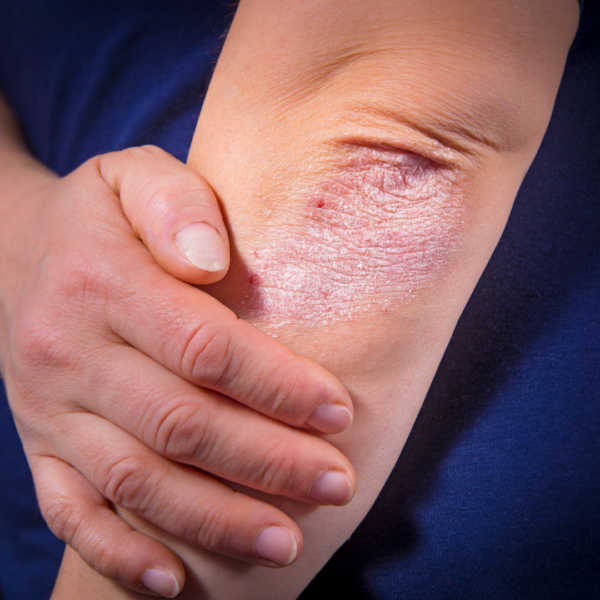 Eczema Treatment Medications, Remedies & Probiotics