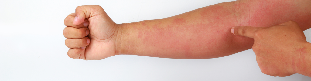 What Is The Atopic Triad?