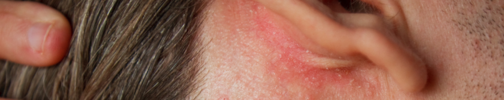 Ear Eczema