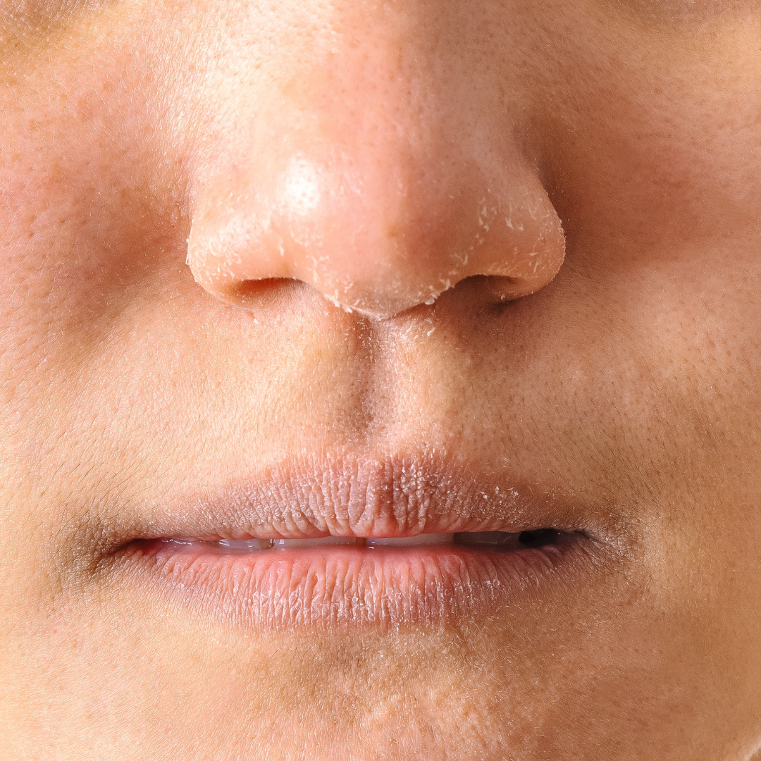 Eczema On Lips