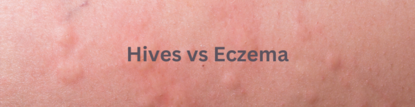 Hives vs Eczema