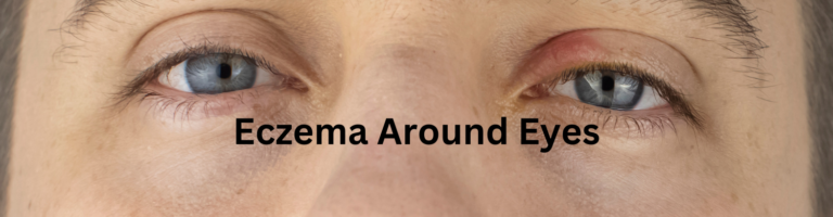 Eczema Around Eyes