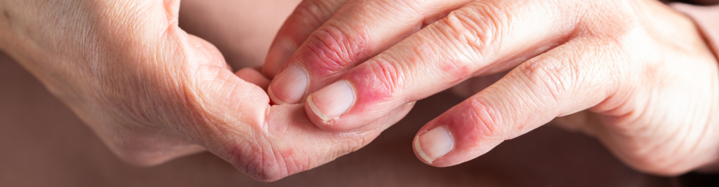 The Impact of Atopic Dermatitis on the Hands