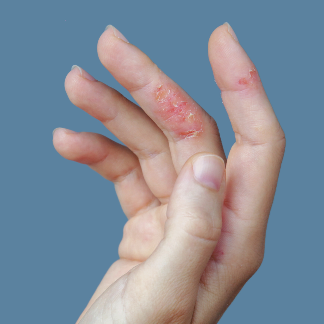 The Impact of Atopic Dermatitis on the Hands