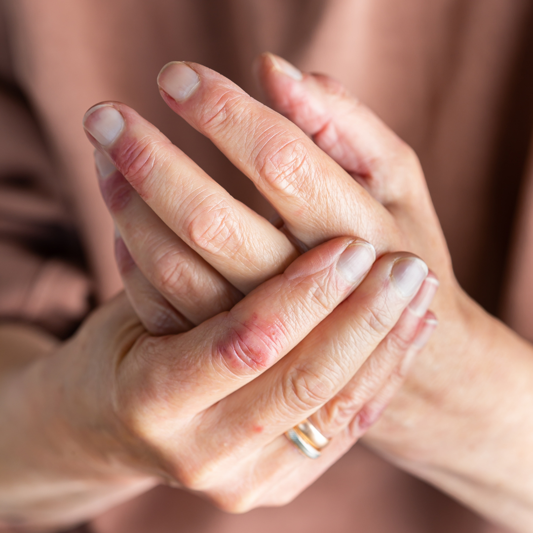 Hand Eczema Solutions